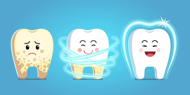 Zahnstein- Das Wichtigste im Überblick! - Donau Dental